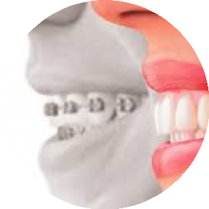 invisalign